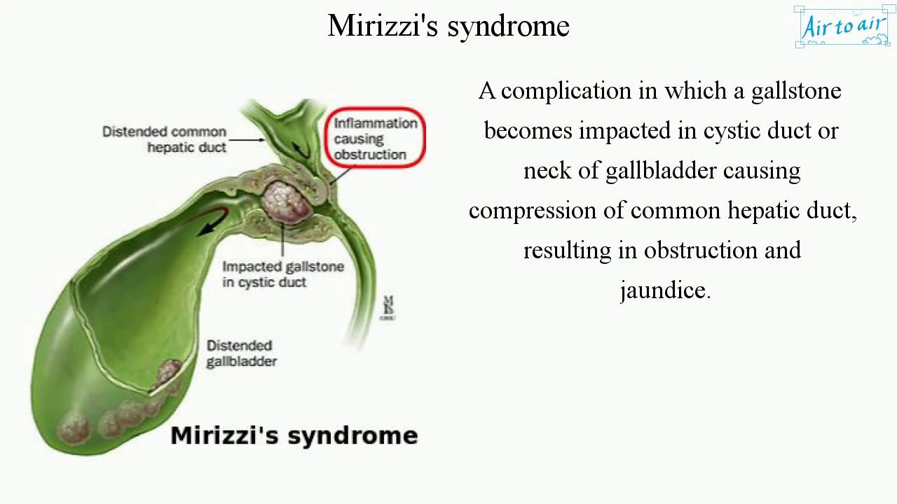 Mirizzi's syndrome - YouTube