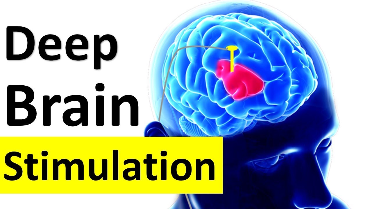 Deep Brain Stimulation | University of California, San Francisco (UCSF ...