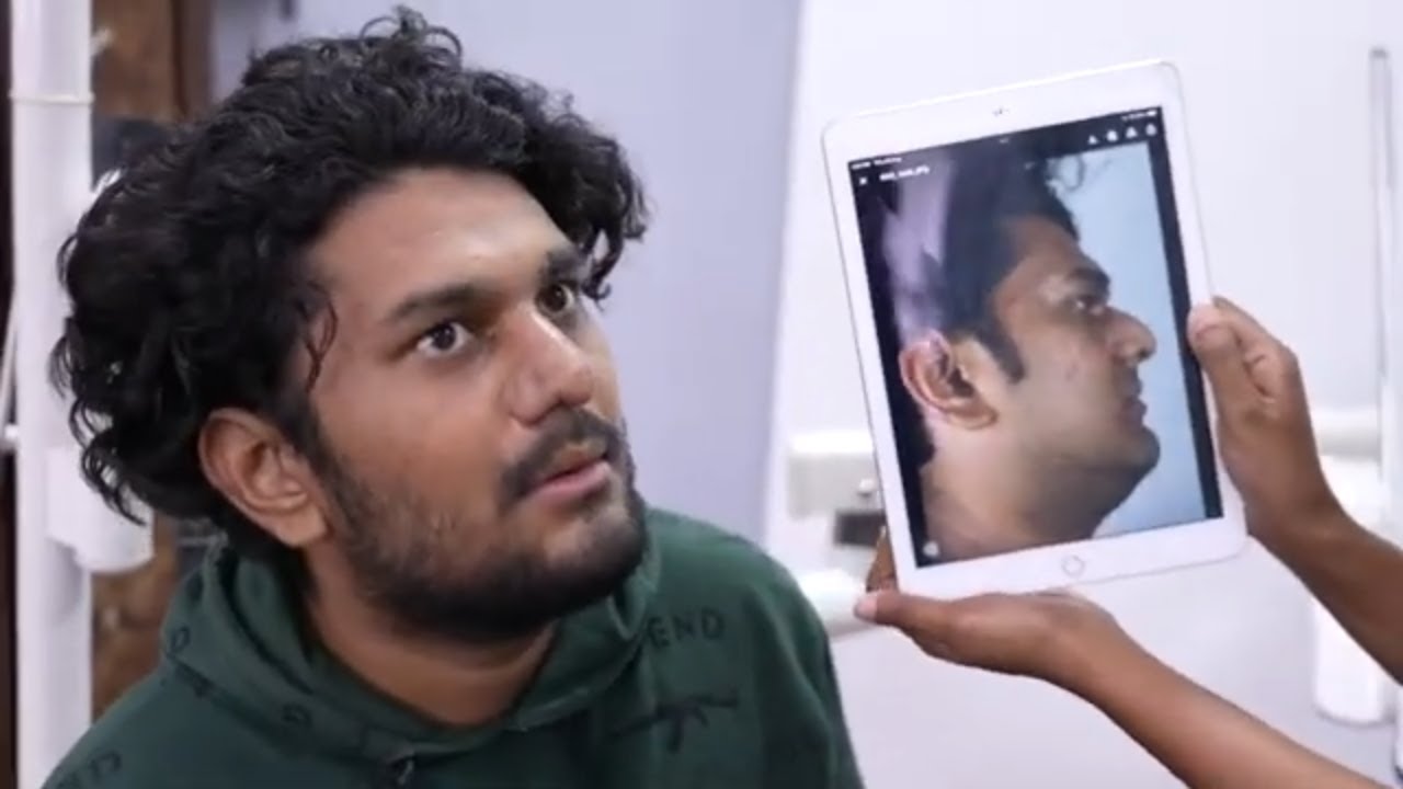 Splint Removal After 5 Weeks of Rhinoplasty | Healing and Progress ...