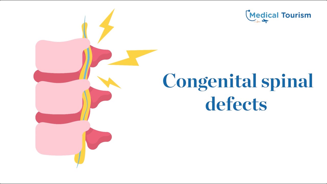 Congenital spinal defects - Medical Tourism - YouTube
