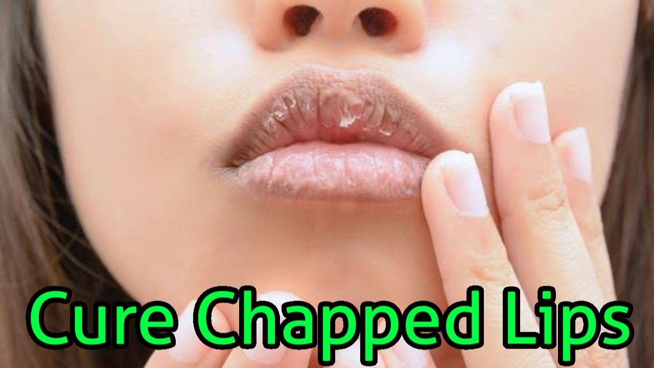 How to: Cure Chapped Dry Lips In 5 Minutes #chappedlips #smilewith ...