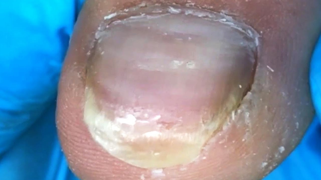 Accidentally injured toenail, cut off the ingrown toenail #Pedicure ...