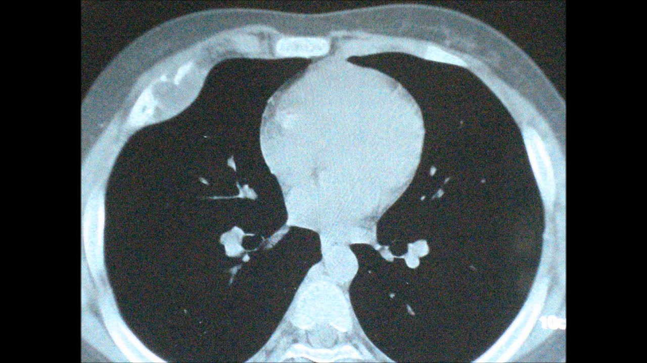 TUBERCULAR ABSCESS( COLD Abscess ) Anterior Chest Wall.HOW TO MANAGE ...