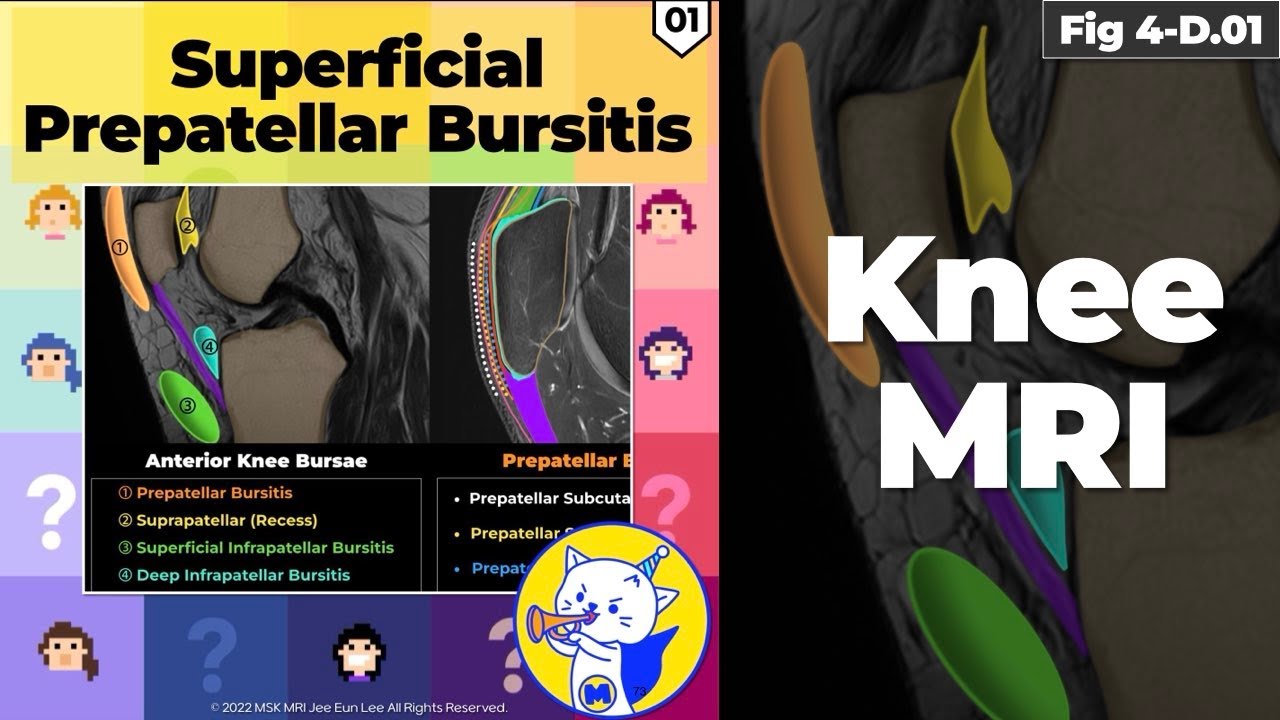 (Fig 4-D.01) Superficial Prepatellar Bursitis in Gout - YouTube