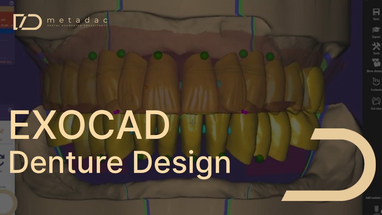 Exocad Ruthinium Digital Dentures: A Full Workflow - YouTube