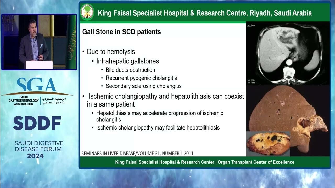 Dr Bandar Odaibi SDDF 2024 - YouTube