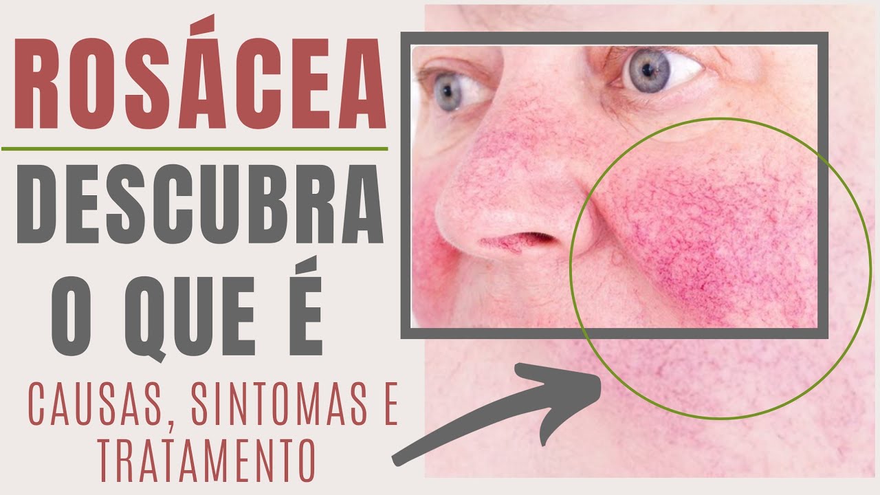 ROSÁCEA - DESCUBRA O QUE É (CAUSAS, SINTOMAS, TRATAMENTO) - YouTube