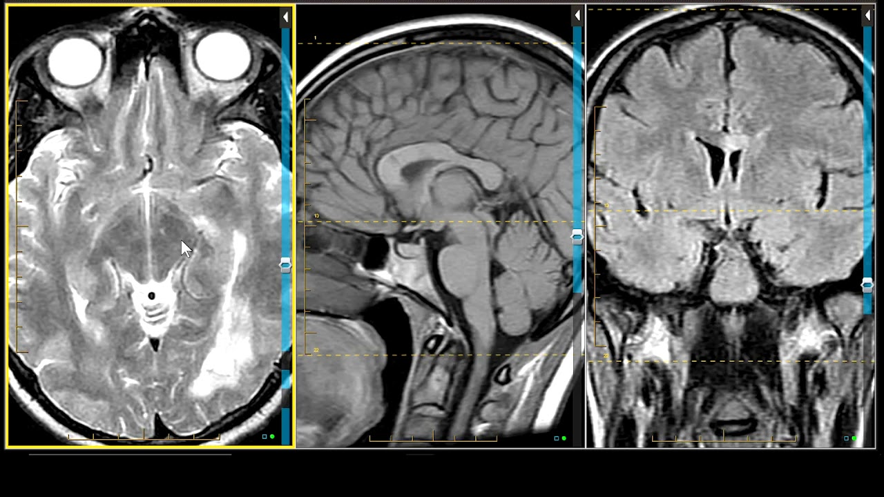 Structure and Function of the Movement Anatomy on MRI - Huntington's ...