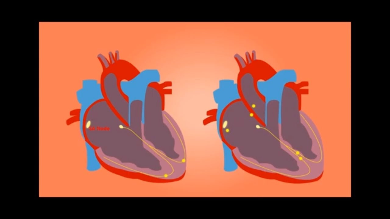 Atrial Fibrillation Review | Afib | Animation - YouTube