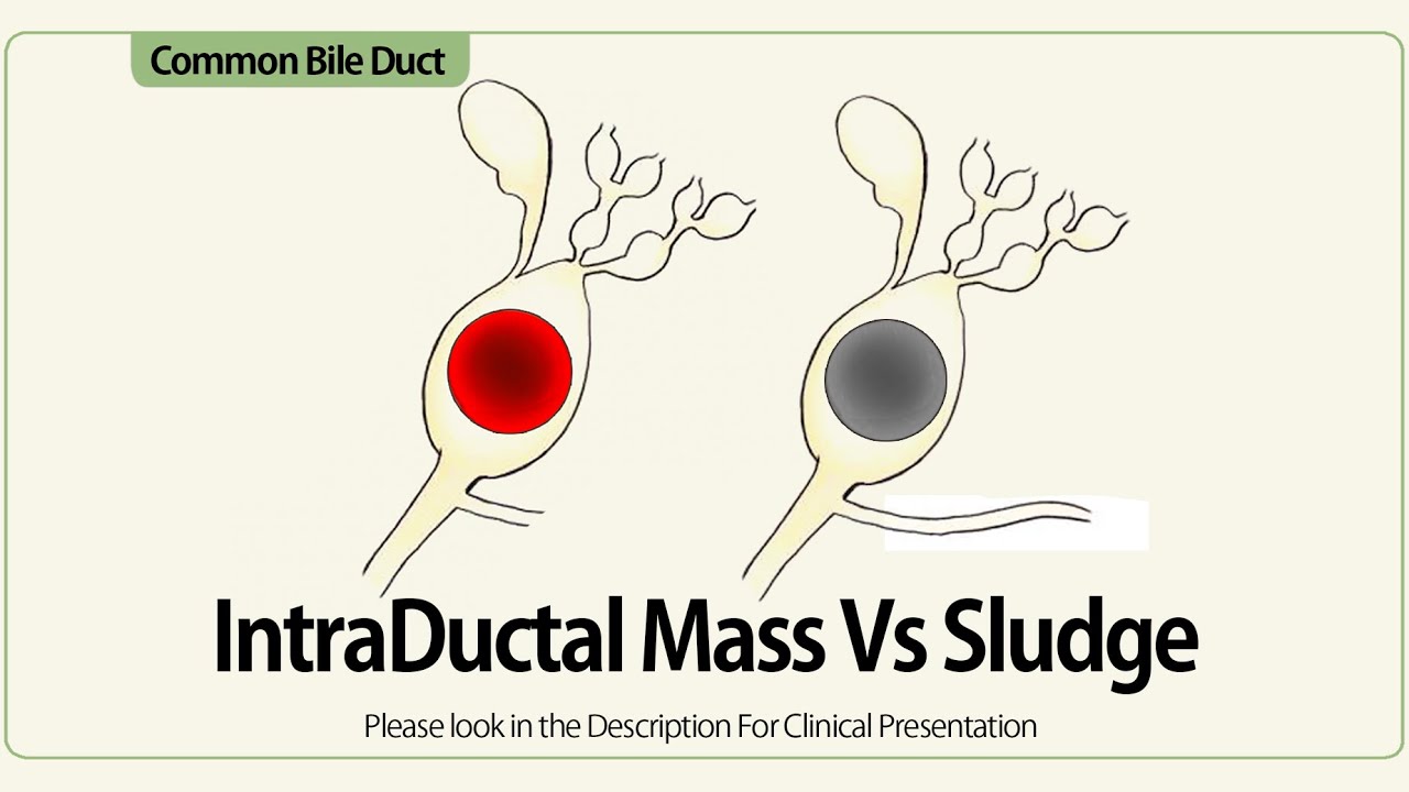 Linear EUS : IntraDuctal Mass Vs Sludge - YouTube