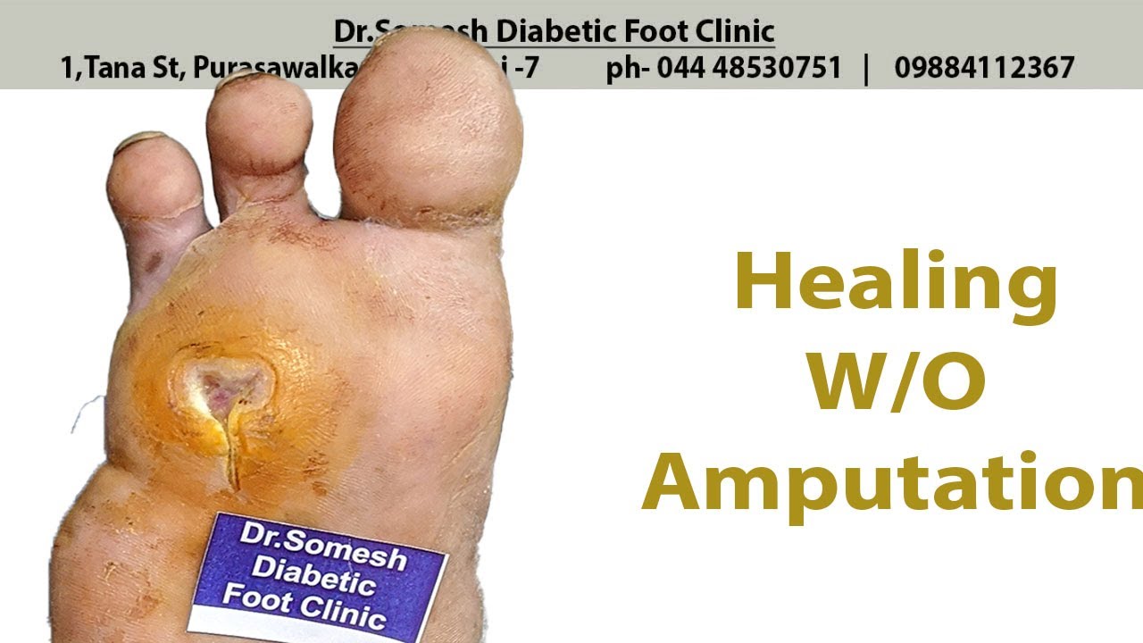 Trophic Ulcer Healing - YouTube