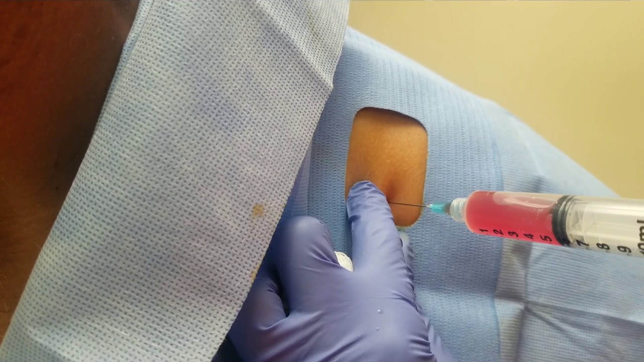 See how Dr. Pickens does PRP Injections for Shoulder Pain - YouTube