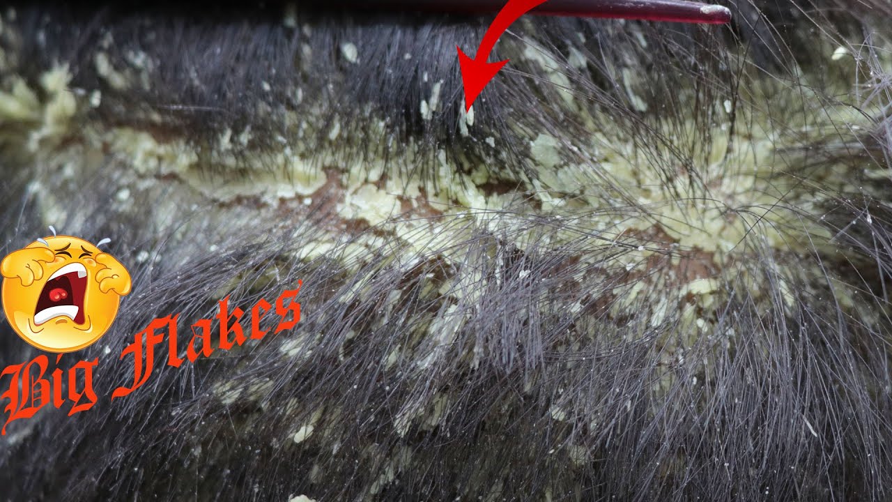 Unbelievable!! Million Worms Founding On Largest Dandruff Flakes of ...