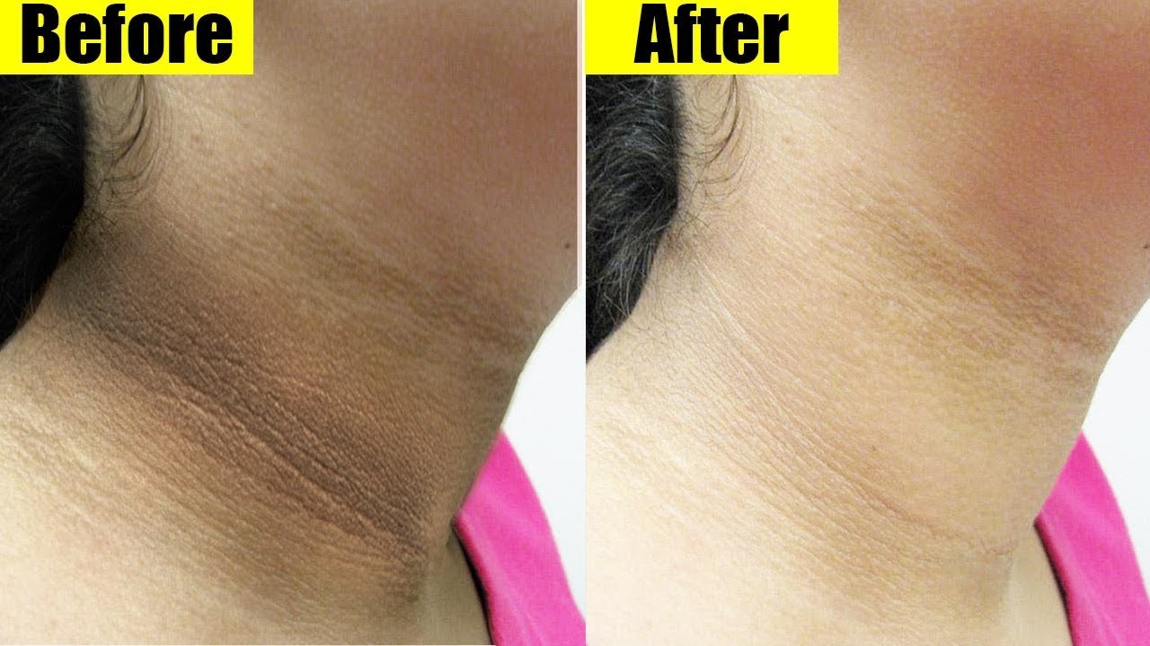 "Top Home Remedies for Dark Neck: Say Goodbye to Black Neck!" - YouTube