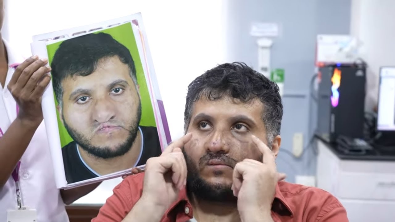 Transformative Rhinoplasty Nose Job Post Operative Results - YouTube