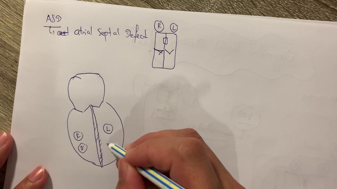 Congenital Heart Diseases ជំងឺបេះដូងប្រហោងពីកំនេីត Part5 (Dr. Prom ...