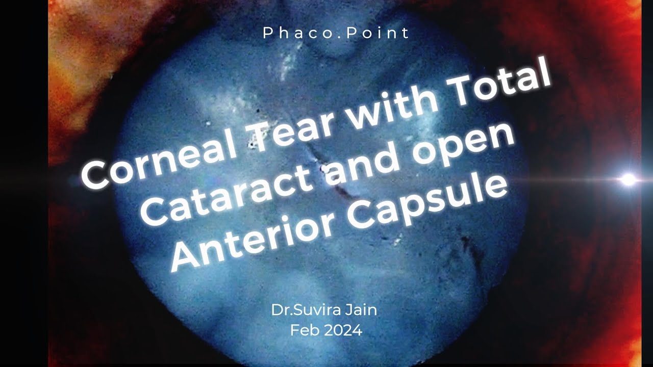 Corneal Tear with Total Cataract and Disrupted Anterior Capsule - How I ...