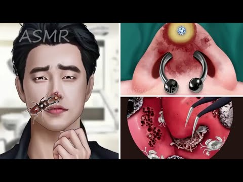 Asmr nose infection animation | nose infection cleaning - YouTube