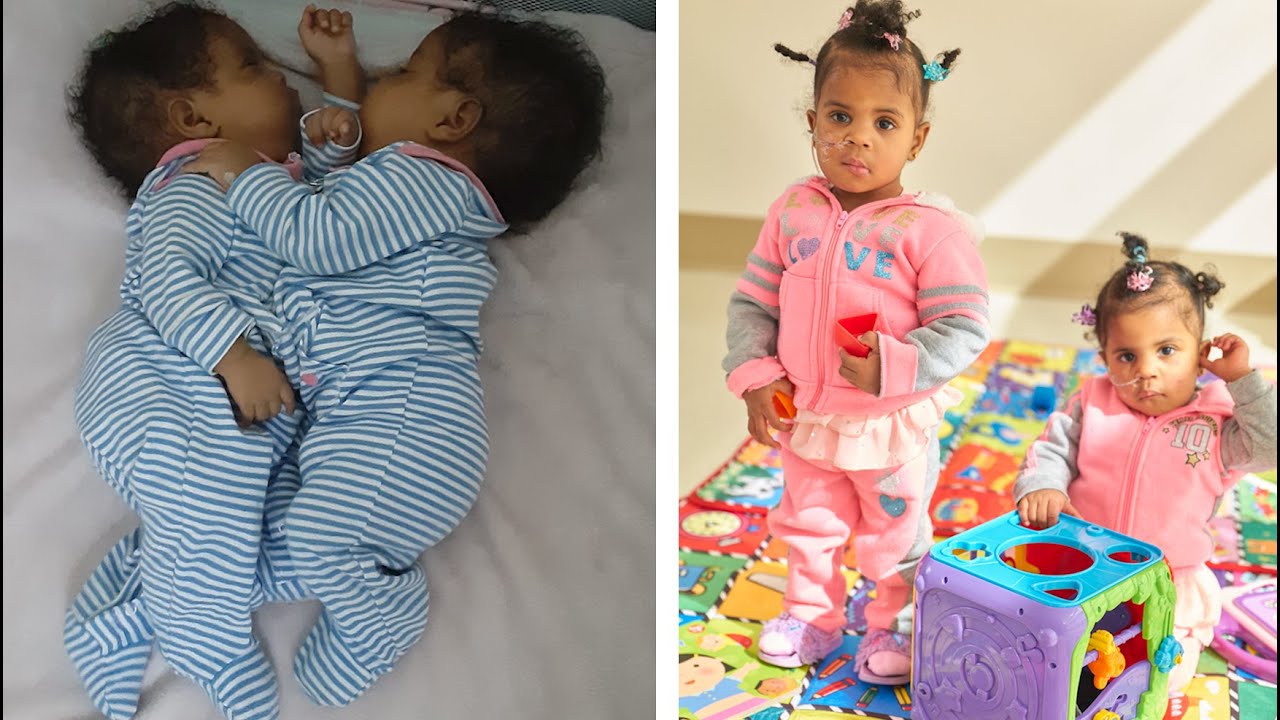 Separating Conjoined Twins - YouTube