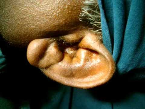 Pseudocyst pinna management video - YouTube