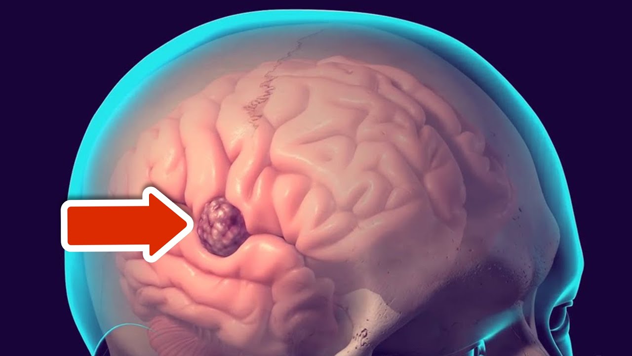 6 Anzeichen eines Gehirntumors, die du NIEMALS ignorieren solltest 💥 ...