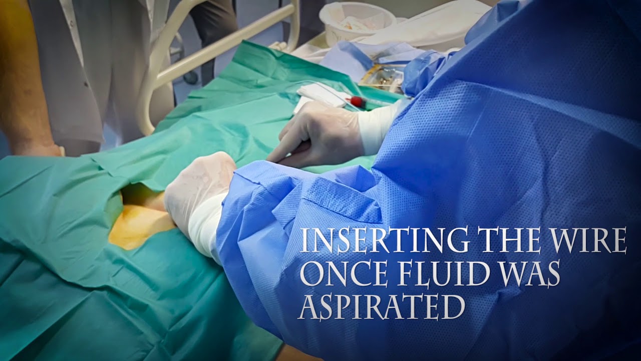 Pericardiocentesis in cardiac tamponade - YouTube