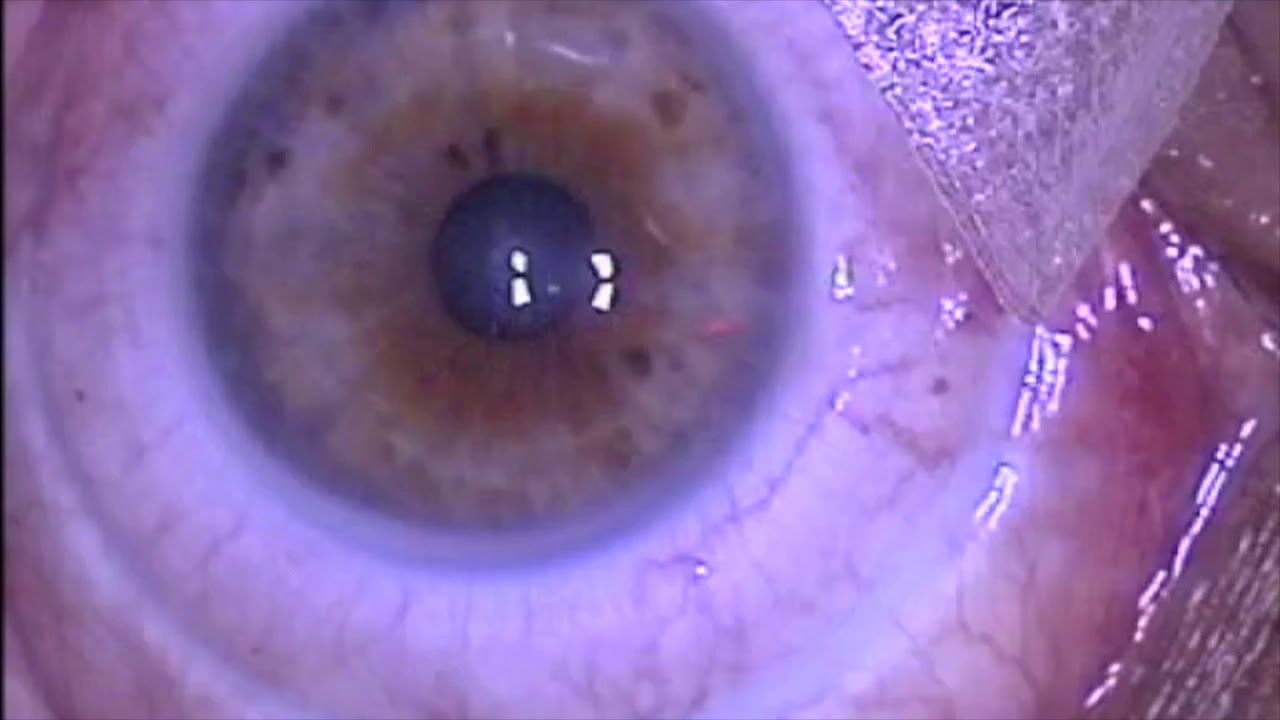 LASIK BUTTON HOLE - YouTube
