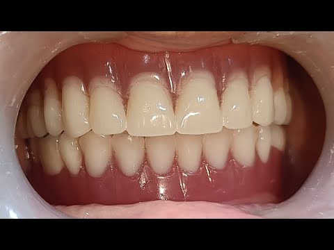 Happy Complete Denture patient with Neutral Zone - YouTube