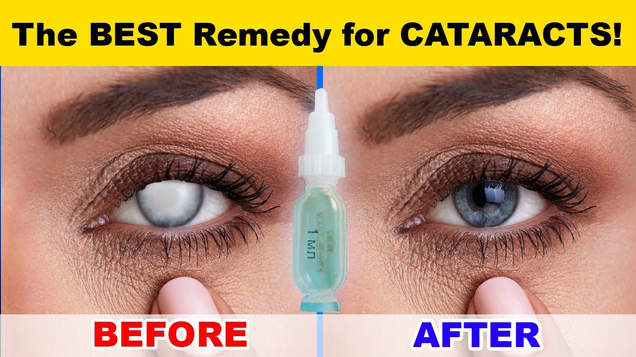 Discover the Ultimate Solution The Best Remedies for Cataracts Revealed ...