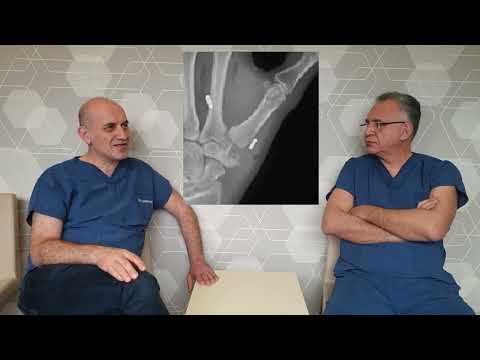 BAŞ PARMAK KÖK AĞRISI (BAŞ PARMAK KİREÇLENMESİ) GENÇ HASTALARDA KAPALI YÖNTEM İLE TEDAVİ