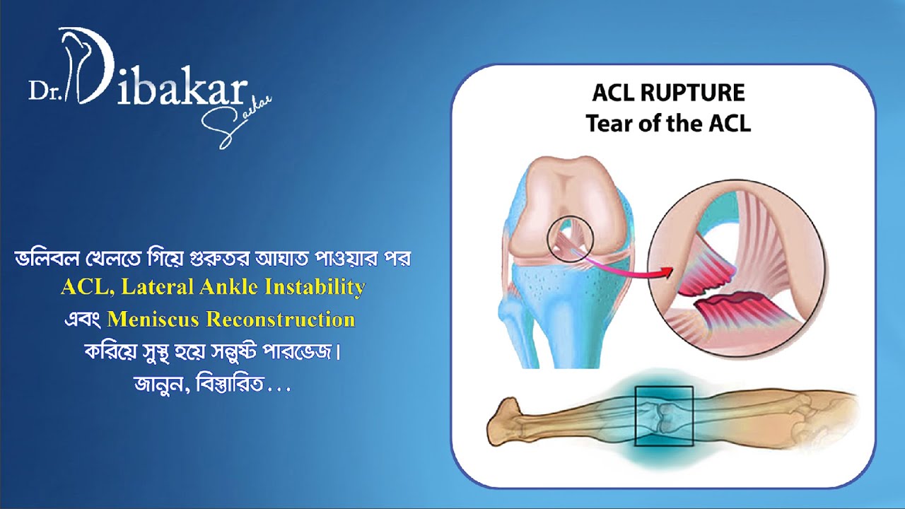 ACL, Lateral Ankle Instability এবং Meniscus Reconstruction করিয়ে ...
