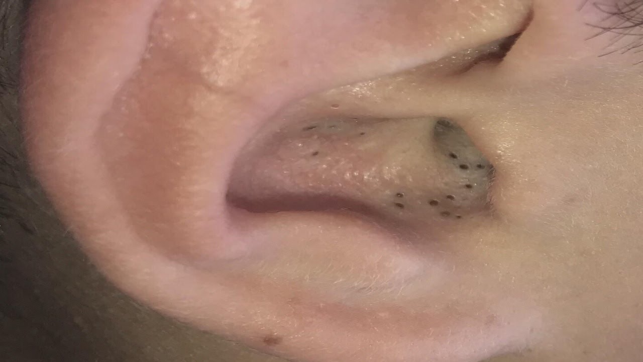 how to get rid of blackheads in your ear in one day - YouTube