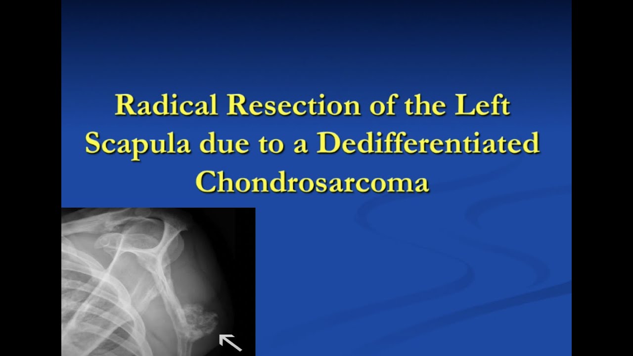 Limb Sparing Resection for a Scapula Dedifferentiated Chondrosarcoma ...