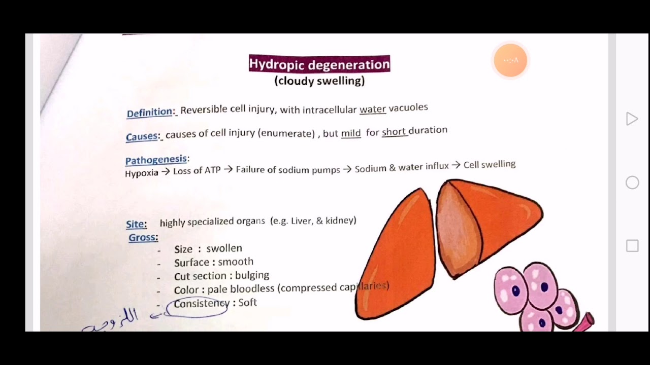 Hydropic degeneration 3.6 - YouTube