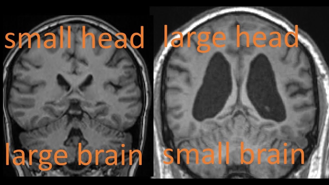 How to adjust brain volumes for age and head size - YouTube