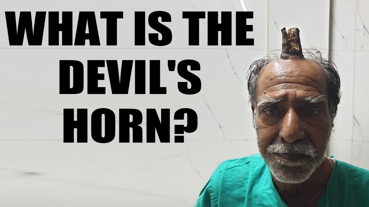 Man gets 'Devil's horn' removed: What is this condition? | Oneindia ...