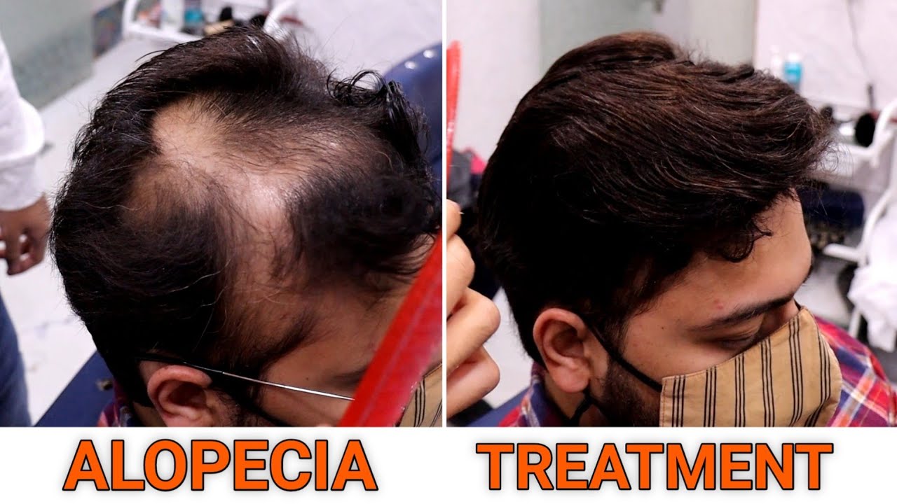 Alopecia Treatment with Hair Patch| Alopecia Spots Cover Up with Hair ...