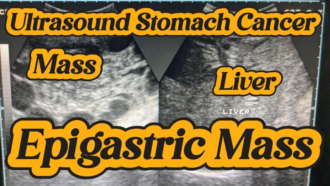 Ultrasound Stomach Cancer | Stomach Mass | Epigastric Mass | Abdomen ...