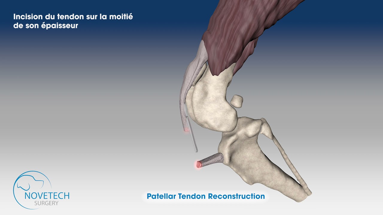 Reconstruction du Tendon Patellaire avec NOVATEN® - YouTube