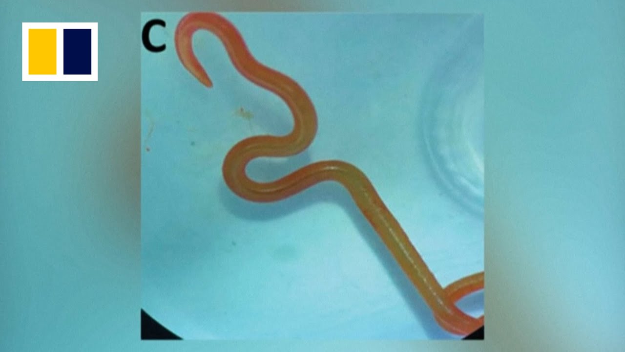 Living worm removed from Australian woman's brain - YouTube