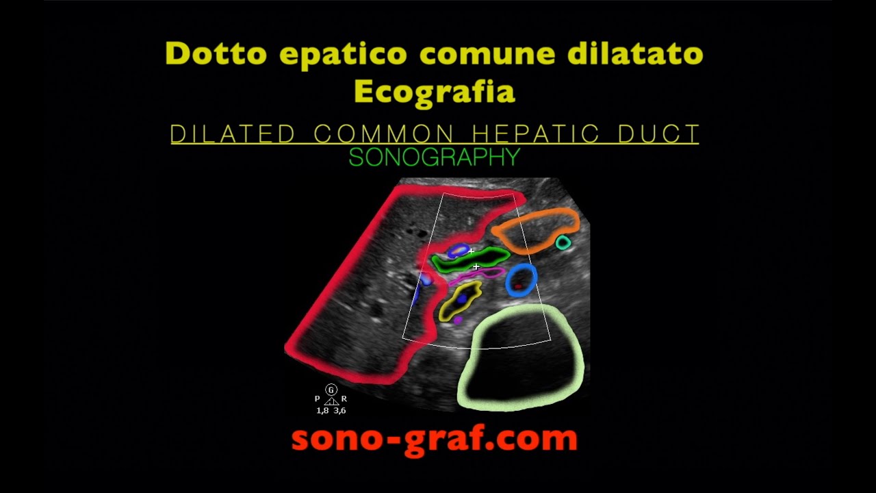 Ecografia - Dotto epatico comune dilatato - YouTube