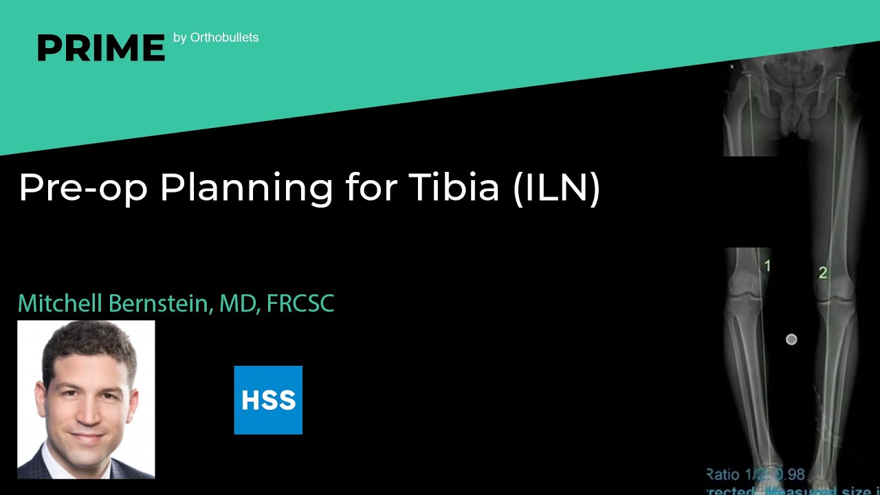 Pre-op Planning for Tibia (ILN) - Mitchell Bernstein, MD, FRCSC - YouTube