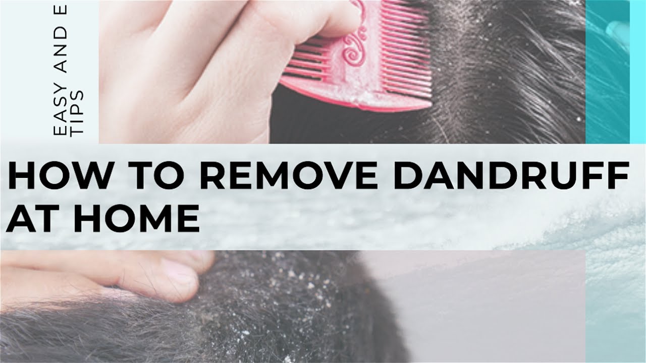 How to remove dandruff from hair at home| बालों से रूसी को घर पर कैसे ...