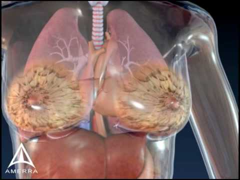 Breast Cancer Biopsy - 3D Medical Animation