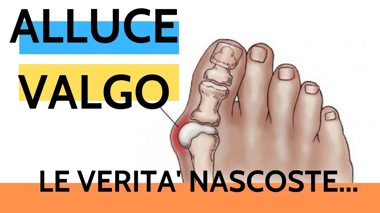 Come curare l'alluce valgo senza intervento? tutte le cause che non ti ...