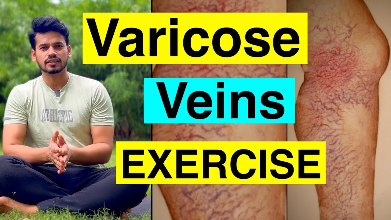 VARICOSE VEINS EXERCISE I पाँवो की नस फूल जाना I Get rid of varicose ...