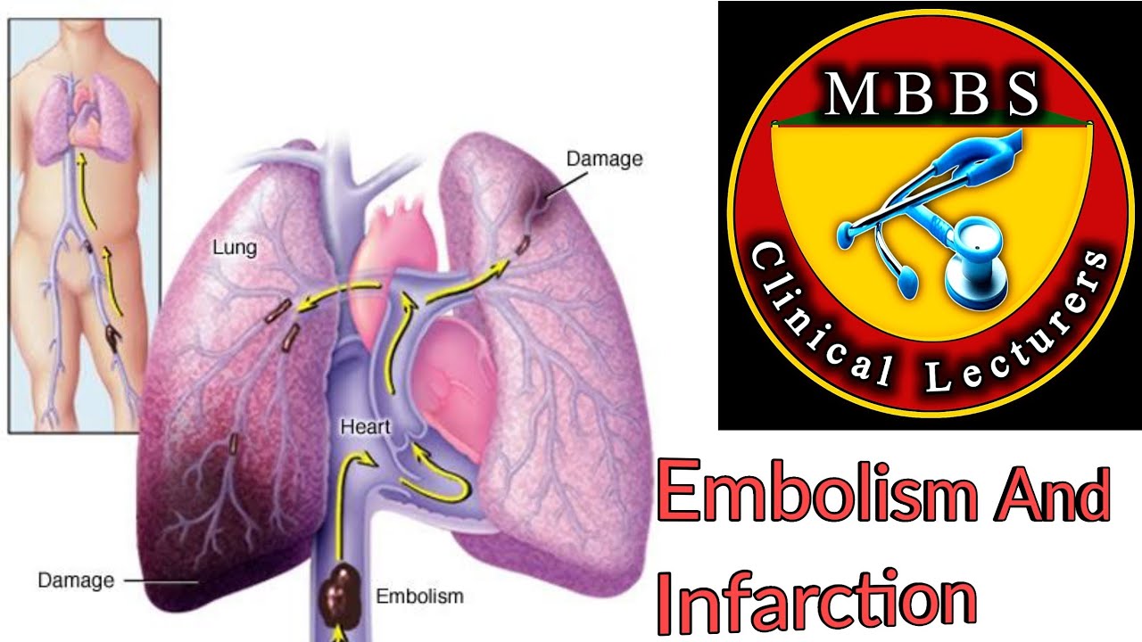 Embolism and Infarction - YouTube