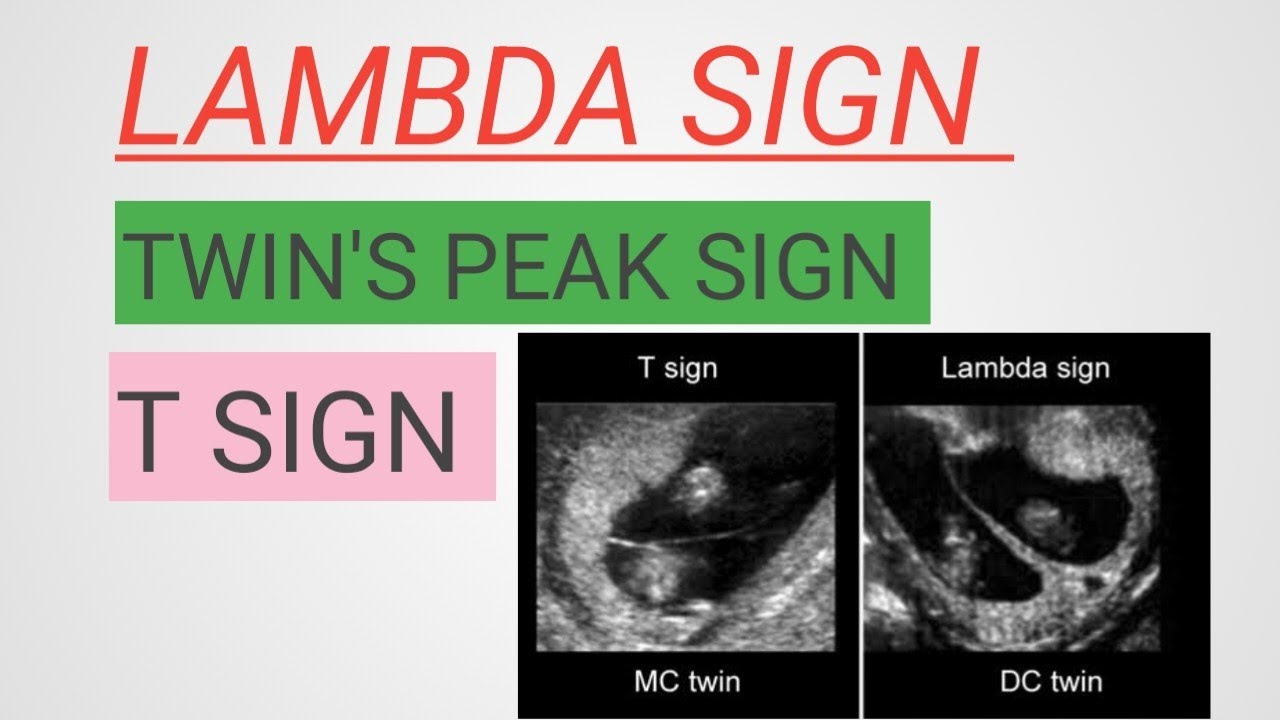 LAMBDA SIGN!TWIN PEAK SIGN!T sign!#youtube#ultrasound#twin#viralvideo#pregnancyscan#youtube# ...