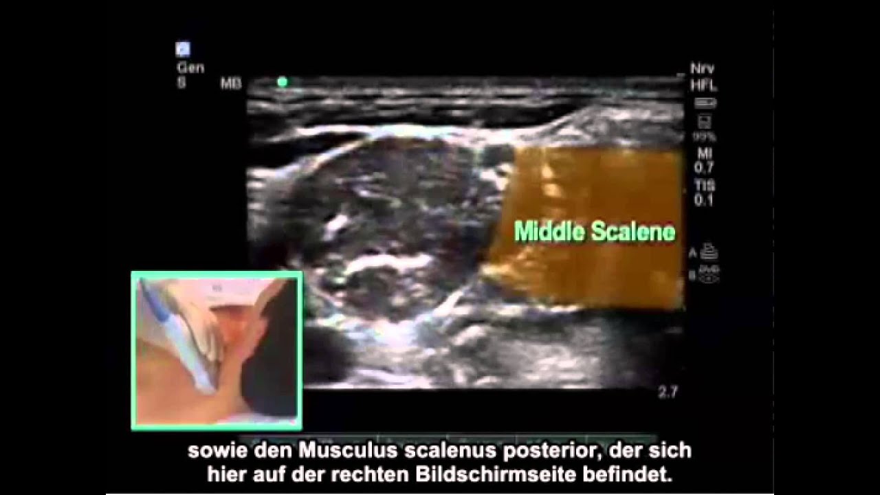 Anleitung: Ultraschallgeführte interskalenäre Nervenblockade des Plexus ...
