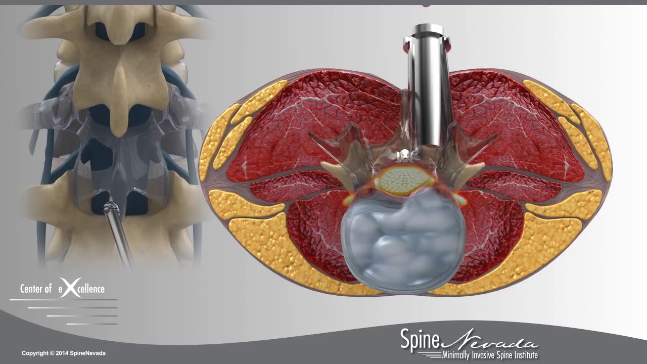 Microdiscectomy (Microdecompression) Spine Surgery - YouTube